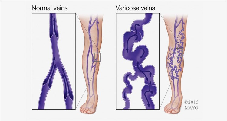 Varicose Veins - Mediveins
