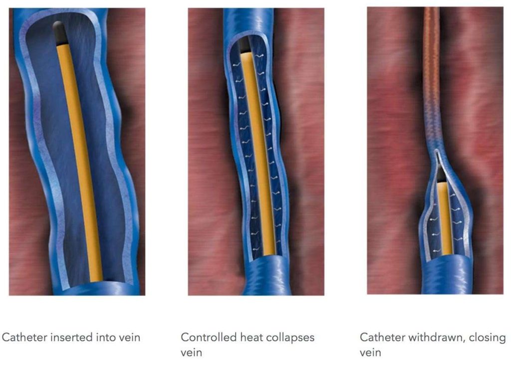Treatment - Mediveins