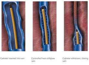 Treatment - Mediveins