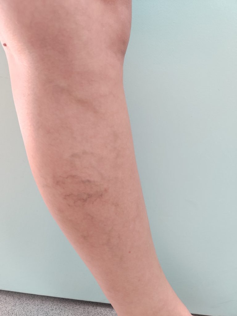 Varicose Veins - Mediveins